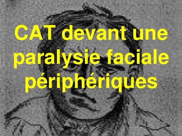 Paralysie Faciale Périphérique